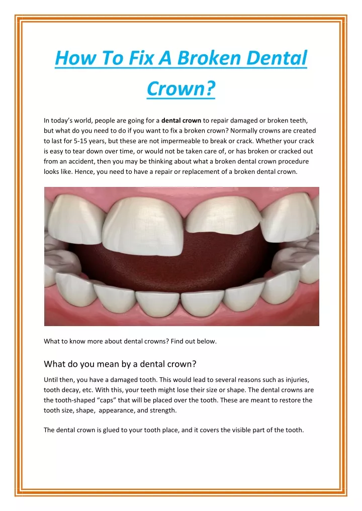 PPT - How To Fix A Broken Dental Crown PowerPoint Presentation, free ...