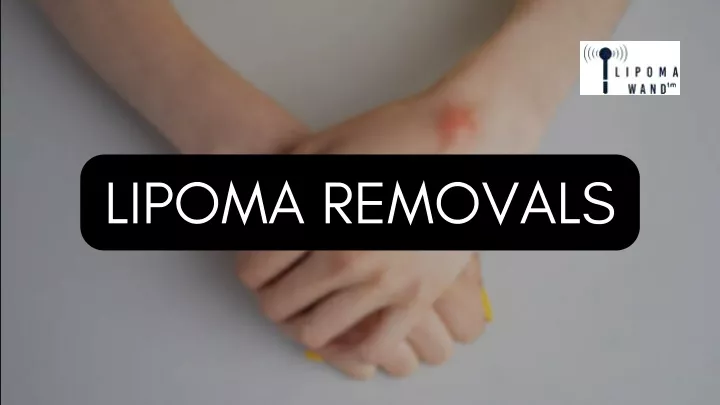 PPT - Want To Know How To Get Rid Of Lipomas? | Lipoma Wand PowerPoint ...