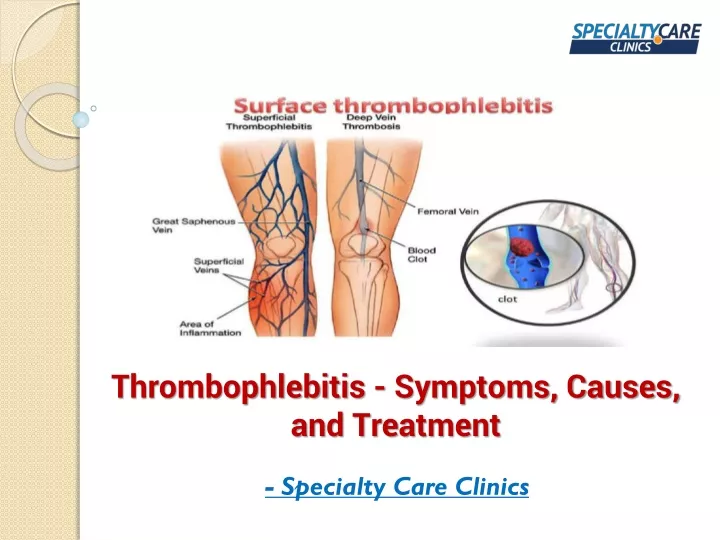 Ppt Thrombophlebitis Symptoms Causes And Treatment Powerpoint Presentation Id11348558