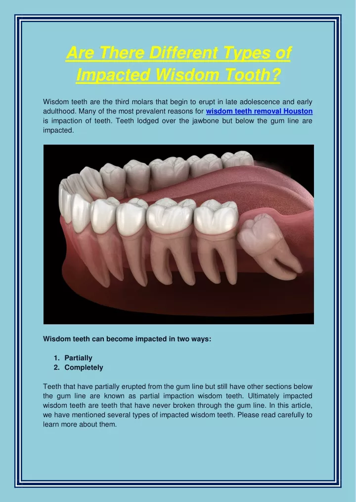 PPT - Are There Different Types of Impacted Wisdom Tooth PowerPoint ...