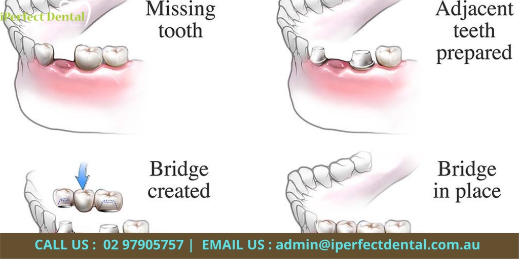 PPT - Dental Crowns and Bridges Bankstown PowerPoint Presentation, free ...
