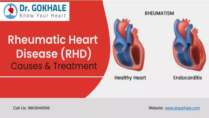 Ppt Rheumatic Heart Disease Rhd Causes And Treatment Dr Gokhale