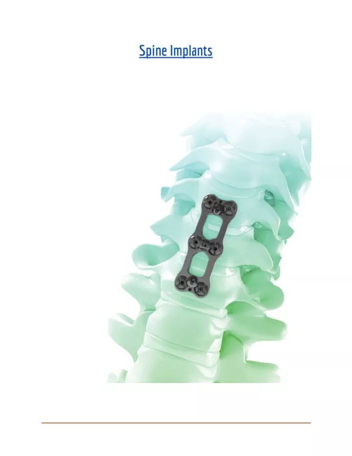 PPT - Spine Implant PowerPoint Presentation, free download - ID:11443125
