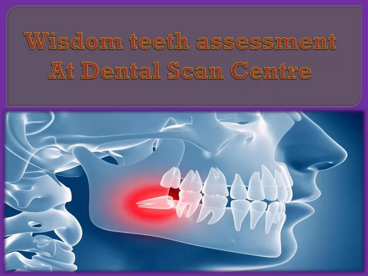 PPT - Wisdom teeth assessment At Dental Scan Centre PowerPoint ...