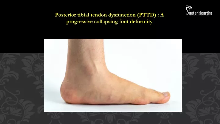 PPT - Posterior tibial tendon dysfunction (PTTD) Footankleortho ...