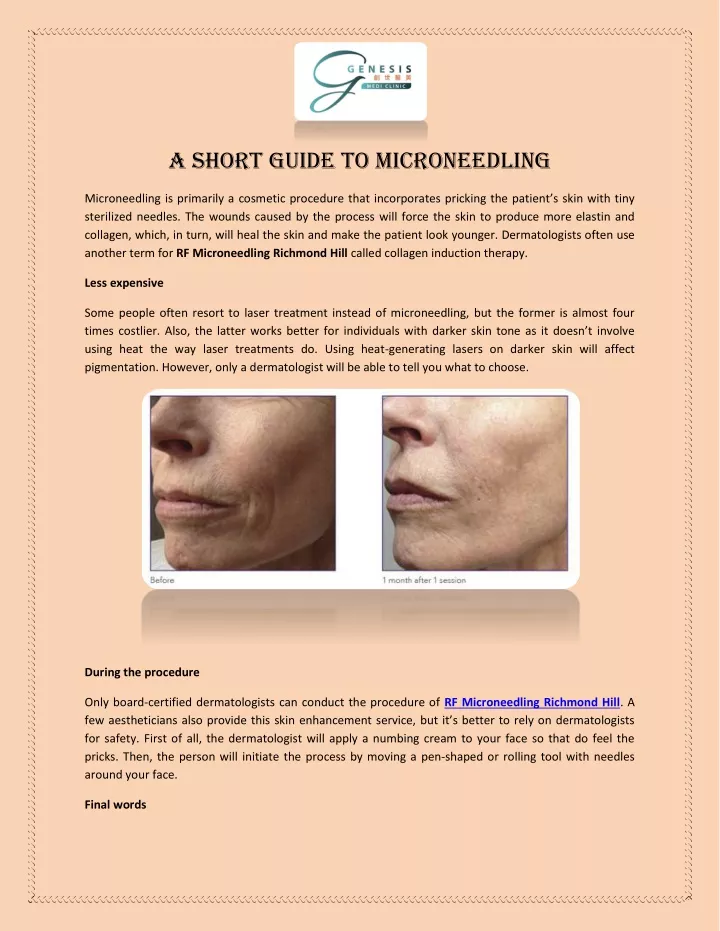 PPT - A Short Guide to Microneedling PowerPoint Presentation, free ...