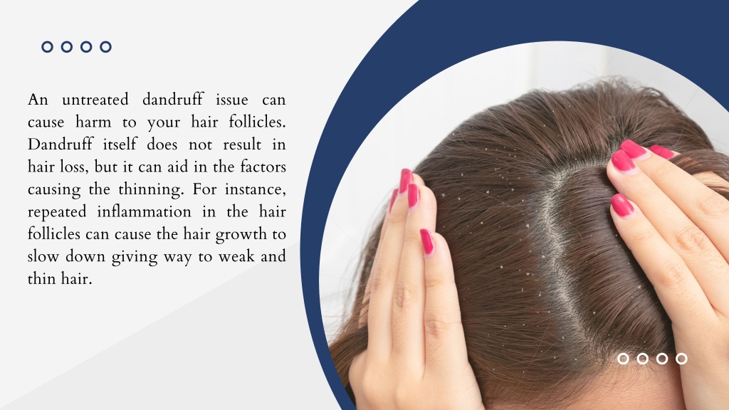 PPT - Best Ayurvedic Oil to Cure Dandruff PowerPoint Presentation, free ...