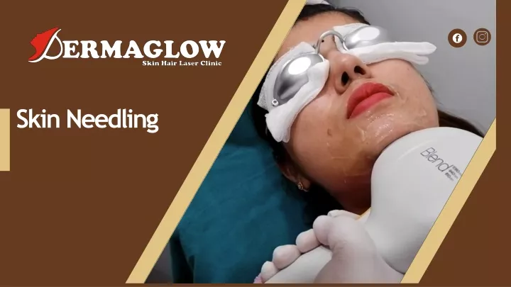 PPT - Skin Needling PowerPoint Presentation, free download - ID:11542263