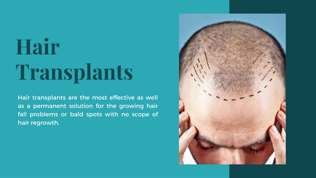 PPT - Guide To Get Effective Solutions For Hair Fall Treatment In ...
