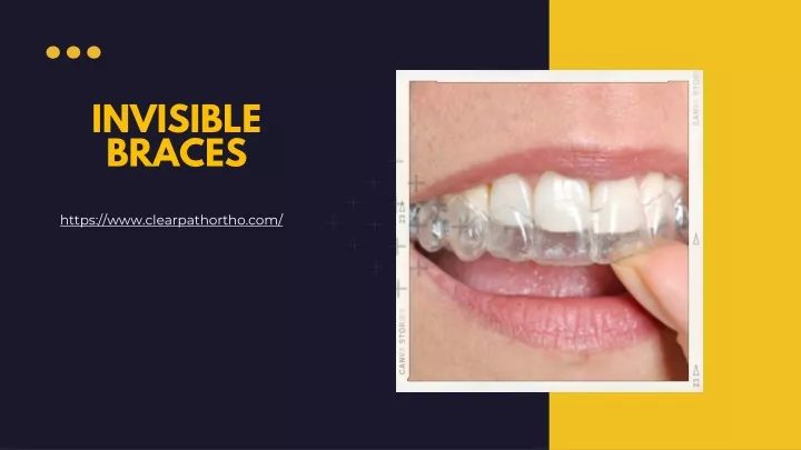 Ppt Invisible Braces Powerpoint Presentation Free Download Id 11577825
