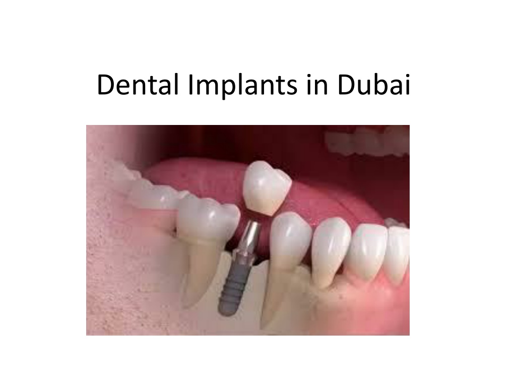 PPT - Dental Implants Dubai PowerPoint Presentation, free download - ID ...