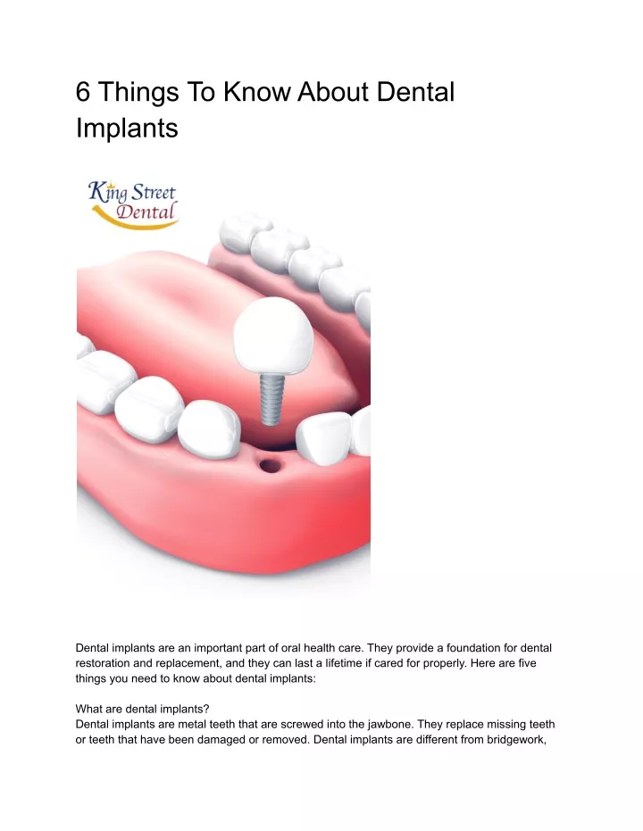 PPT - 6 Things To Know About Dental Implants (1) PowerPoint ...