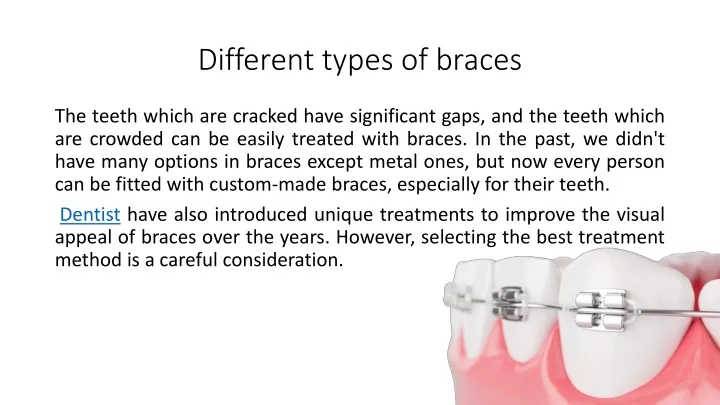 PPT - Different types of braces PowerPoint Presentation, free download ...