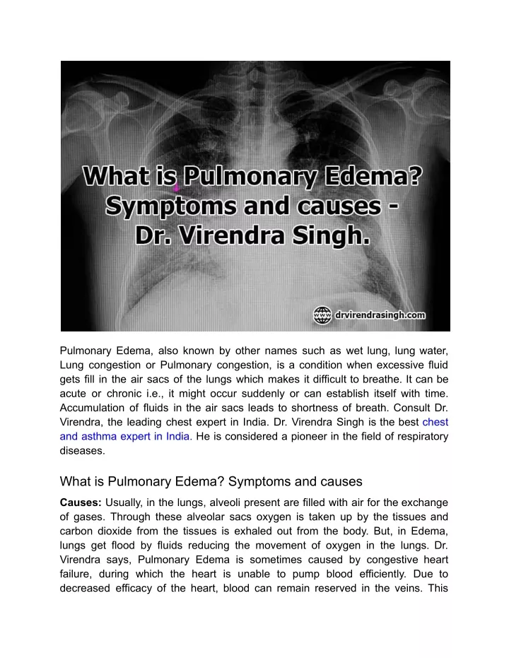 Ppt What Is Pulmonary Edema Symptoms And Causes Dr Virendra Singh Powerpoint Presentation