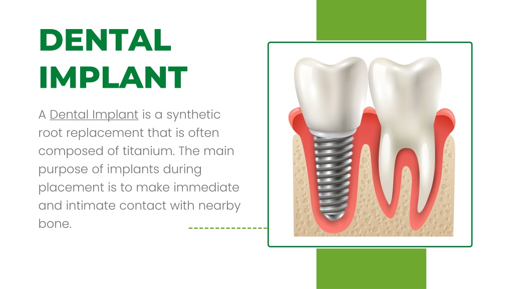 PPT - Dental Implant PowerPoint Presentation, free download - ID:11681401