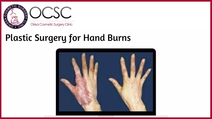 PPT - Plastic Surgery for Hand Burns PowerPoint Presentation, free ...