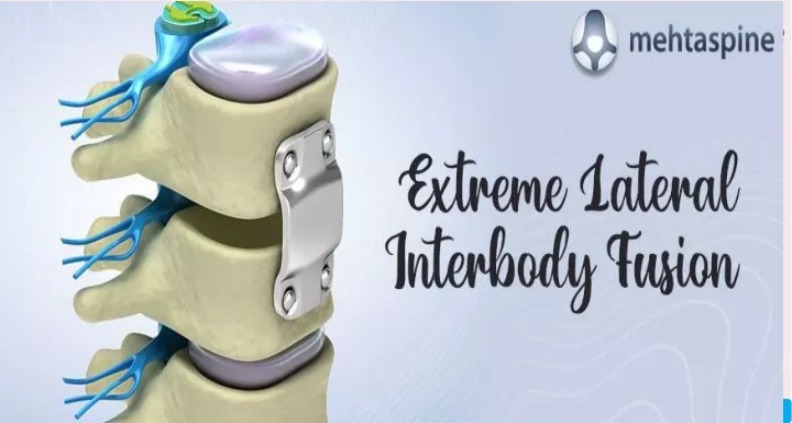 PPT - Lateral Inter-Body Fusion | Nerve Pain After XLIF Surgery ...