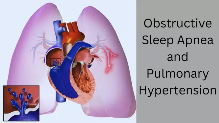 PPT - Obstructive Sleep Apnea and Pulmonary Hypertension PowerPoint ...