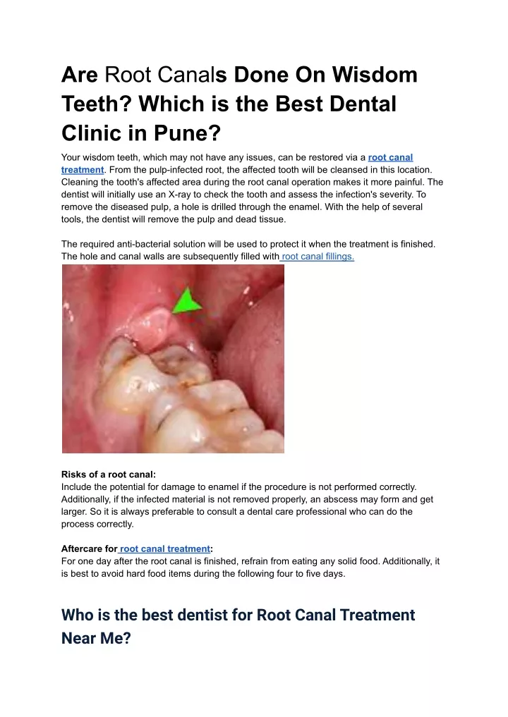 PPT - Are Root Canals Done On Wisdom Teeth PowerPoint Presentation ...