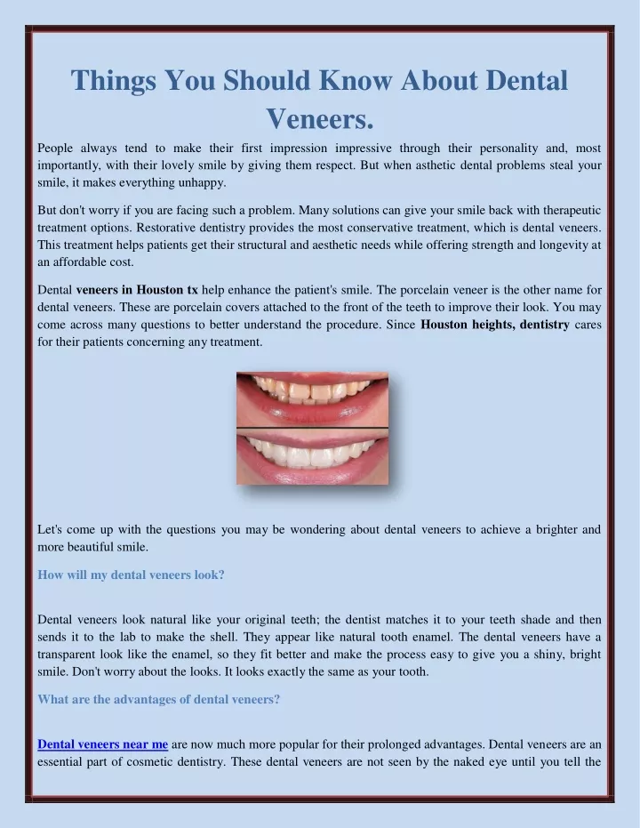 Ppt Things You Should Know About Dental Veneers Powerpoint