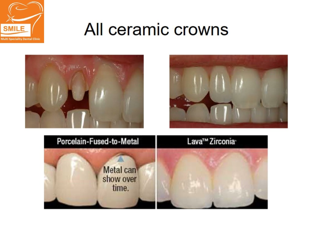 PPT - Root Canal Treatment PowerPoint Presentation, free download - ID ...
