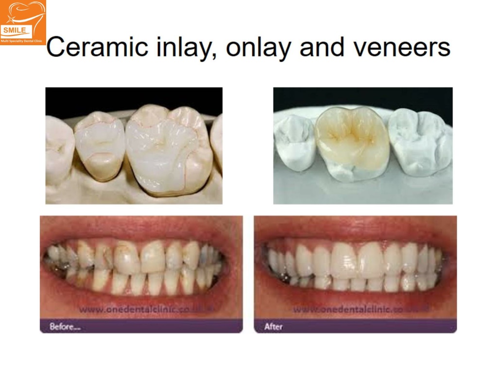 PPT - Root Canal Treatment PowerPoint Presentation, free download - ID ...