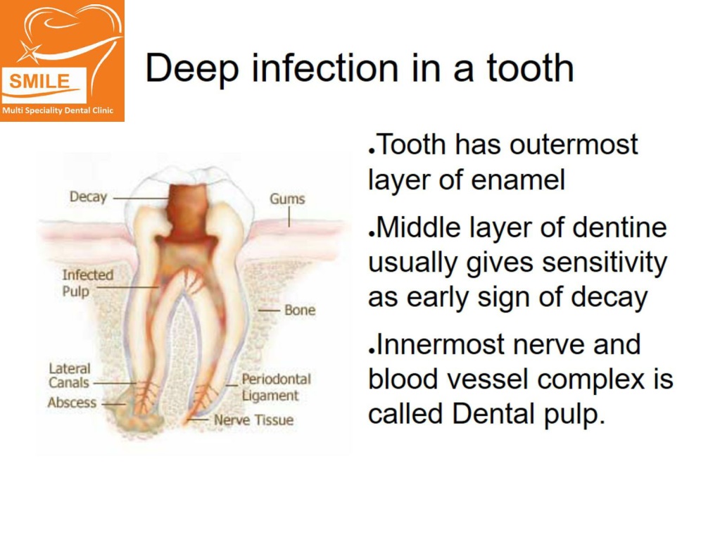 PPT - Root Canal Treatment PowerPoint Presentation, free download - ID ...