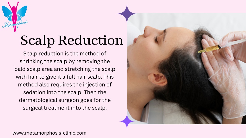 PPT - Types of Latest Treatments for Hair Loss PowerPoint Presentation ...