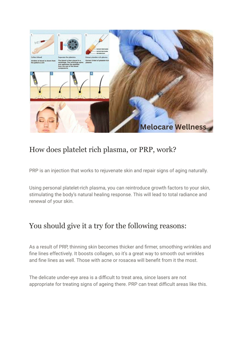 PPT - PRP Treatment in Delhi - Melocare Wellness PowerPoint ...