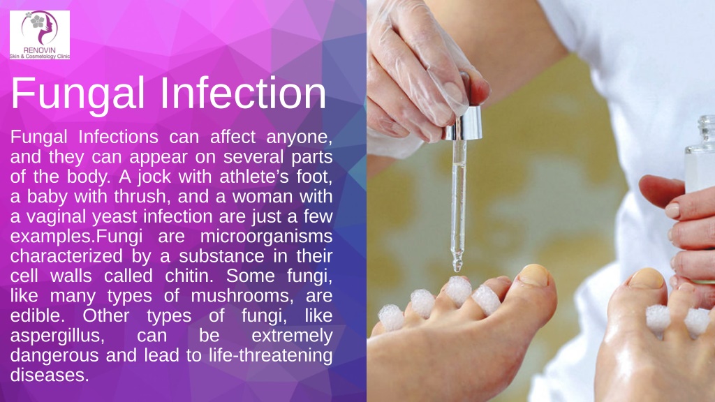PPT - Fungal Infection Specialist Near ME PowerPoint Presentation, free ...