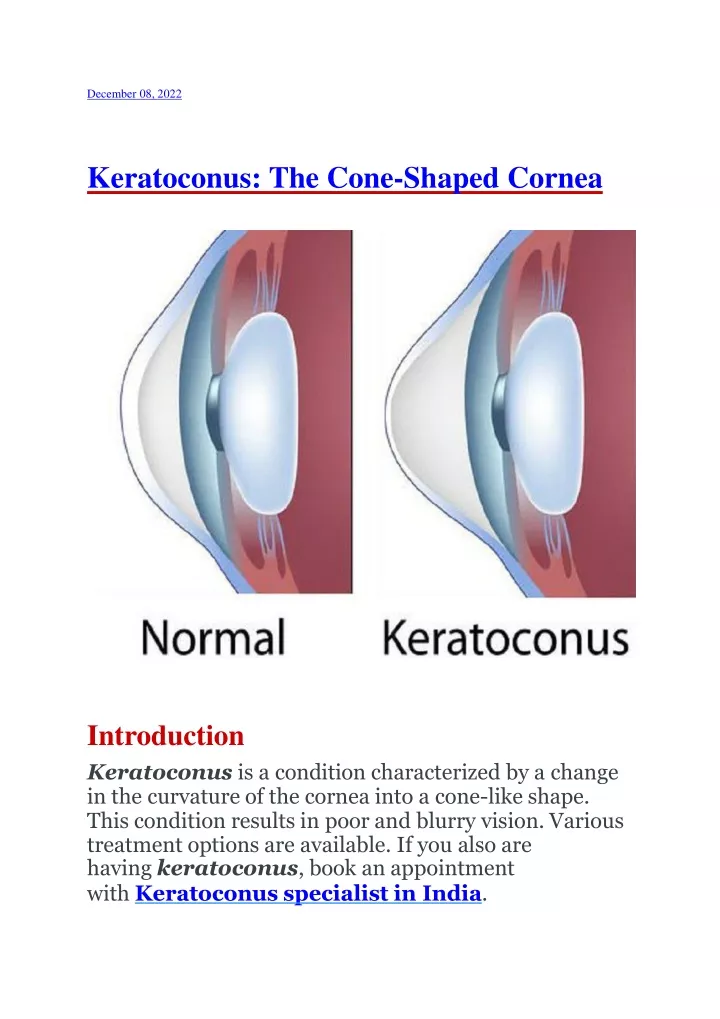 PPT - Keratoconus Surgery In Mumbai By Dr. Niteen Dedhia PowerPoint ...