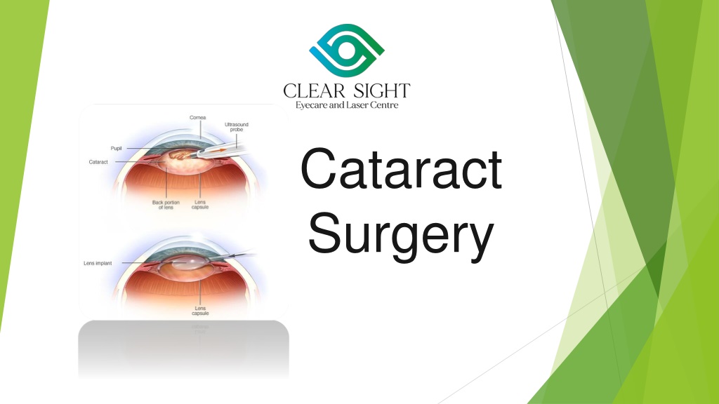 PPT - Cataract Surgery_Dr. Sonia Maheshwari PowerPoint Presentation ...