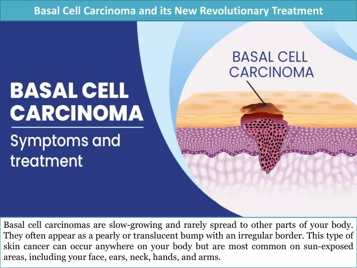 Ppt Basal Cell Carcinoma And Its New Revolutionary Treatment