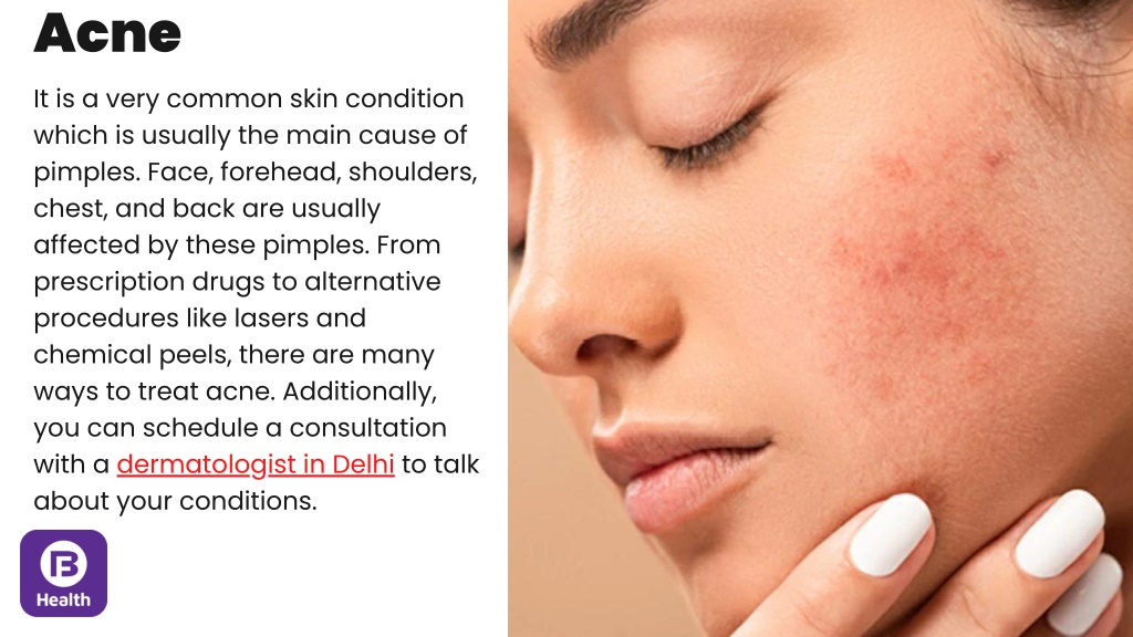 Ppt Types Of Diseases Treated By A Dermatologist In Delhi Powerpoint