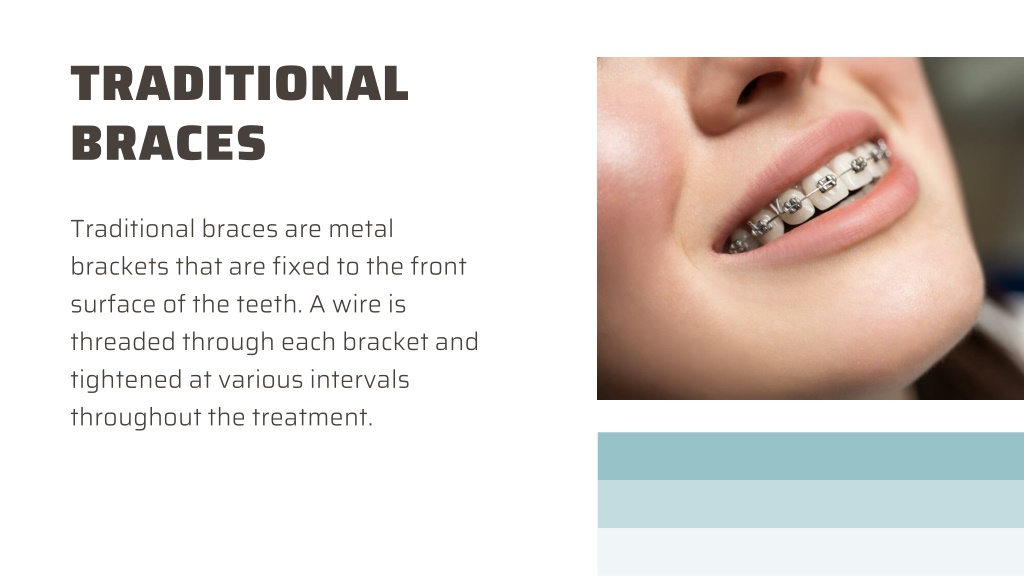 PPT - Pros and Cons of Invisalign and Traditional Braces PowerPoint ...