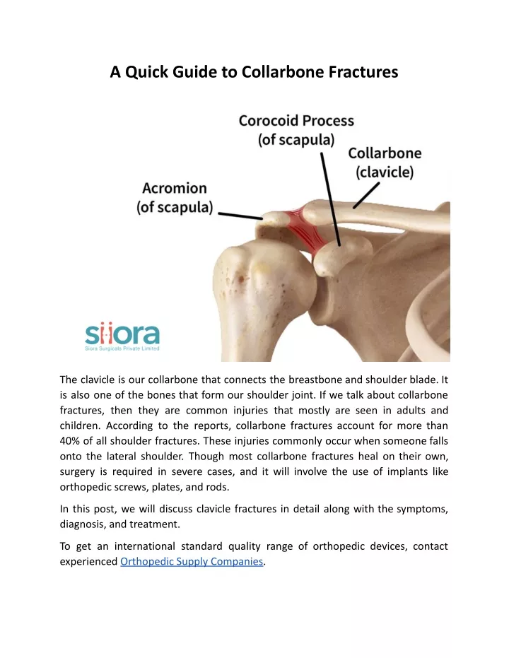 PPT - A Quick Guide to Collarbone Fractures.docx PowerPoint ...