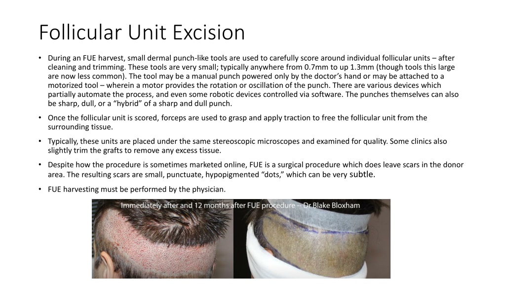 PPT - How a Modern Hair Transplant is Performed PowerPoint Presentation ...