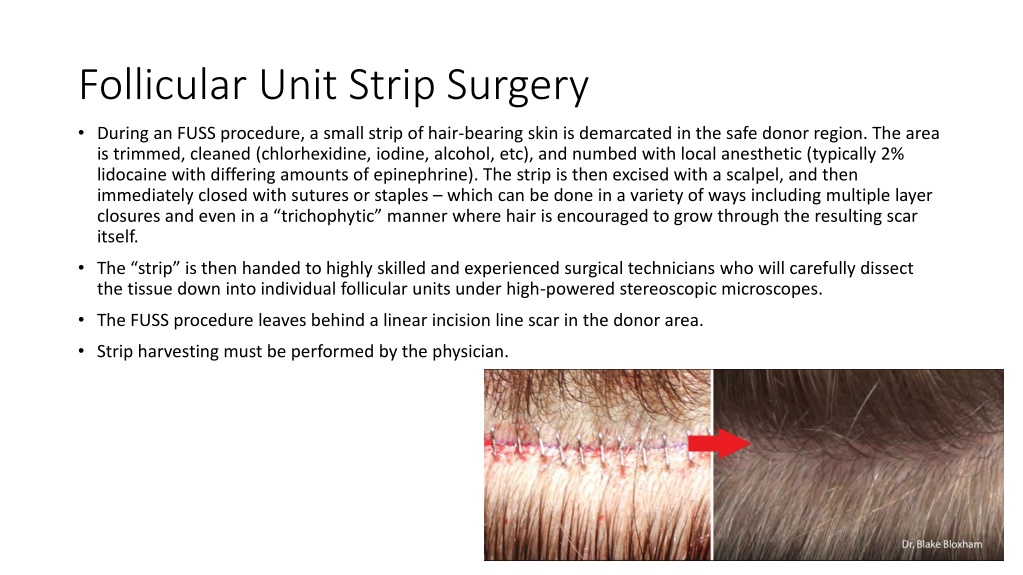 PPT - How a Modern Hair Transplant is Performed PowerPoint Presentation ...