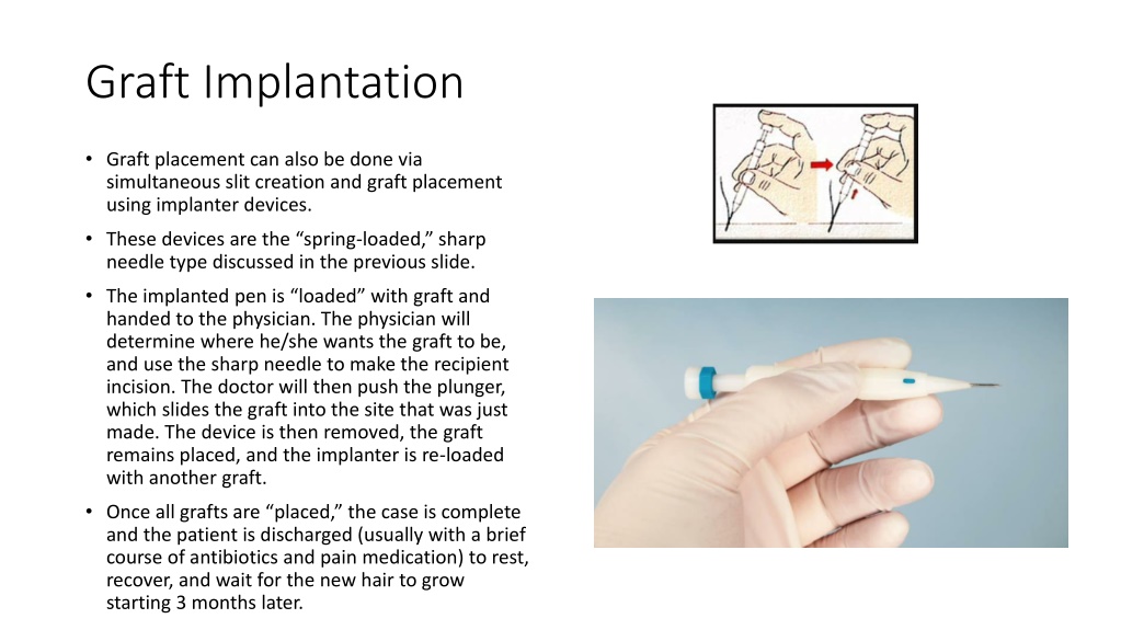 PPT - How a Modern Hair Transplant is Performed PowerPoint Presentation ...