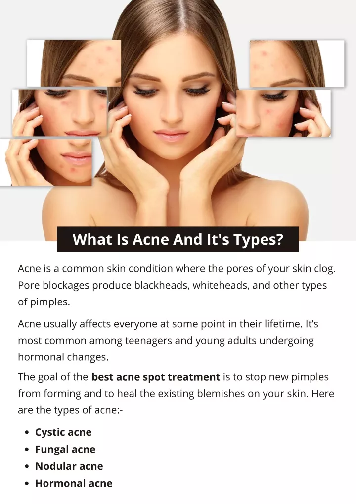 PPT - What Is Acne And It's Types PowerPoint Presentation, free ...