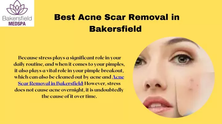 Ppt Get The Best Acne Scar Removal Treatment In Bakersfield For