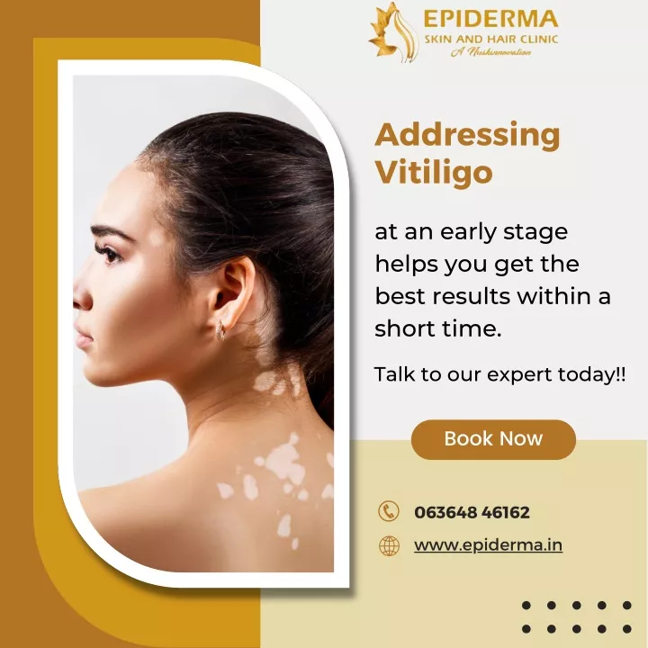 PPT - Address Vitiligo at an early stage - Skin Clinic in Jayanagar ...