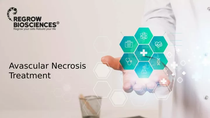 PPT - Avascular Necrosis Treatment: Why cell therapy is a popular ...