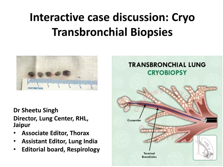 PPT - BRONCHUS 2020 Interactive case discussion Cryo Transbronchial ...