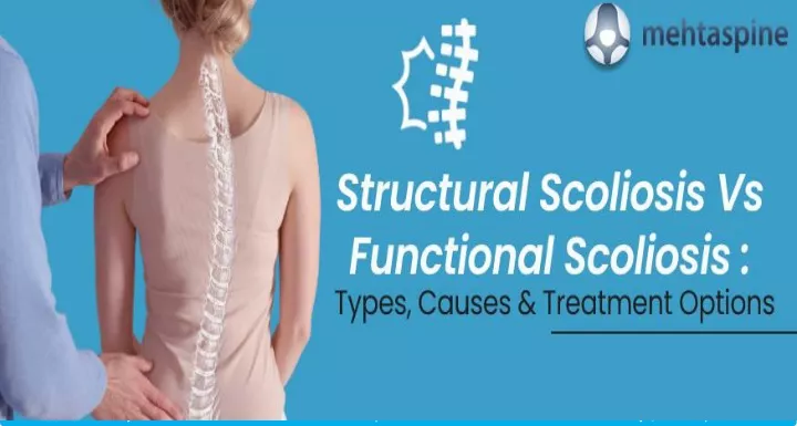 PPT - Structural Scoliosis Vs Functional Scoliosis PowerPoint ...