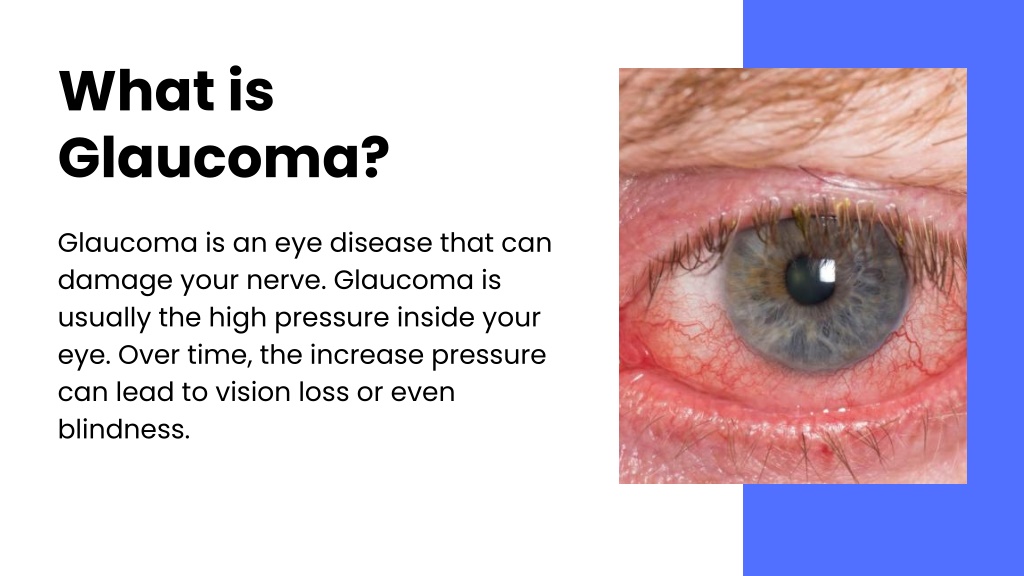 PPT - What are the main causes oF Glaucoma PowerPoint Presentation ...