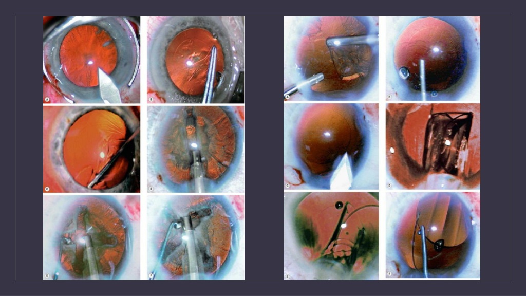 PPT - Cataract 1 lecture pmcajk PowerPoint Presentation, free download ...