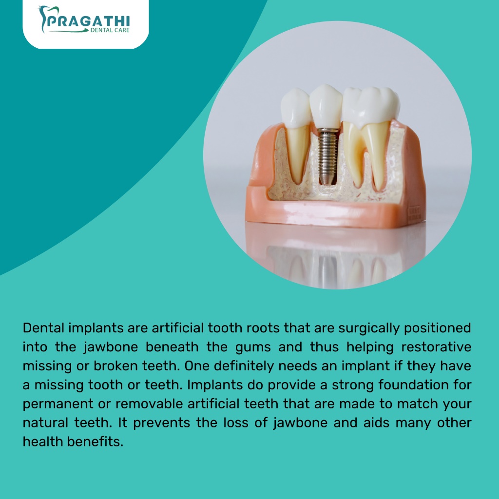 PPT - Best Dental Implants in RR Nagar, Bangalore Pragathi Dental ...