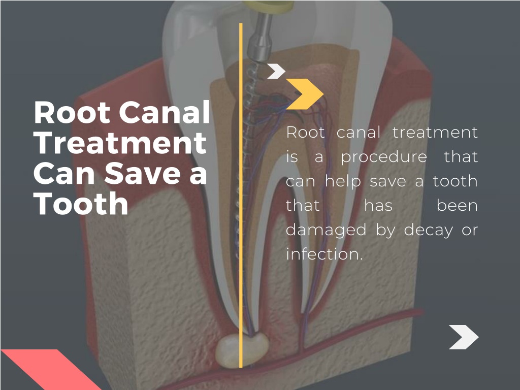 PPT - 10 Surprising Facts You Didn't Know About Root Canal Treatment ...
