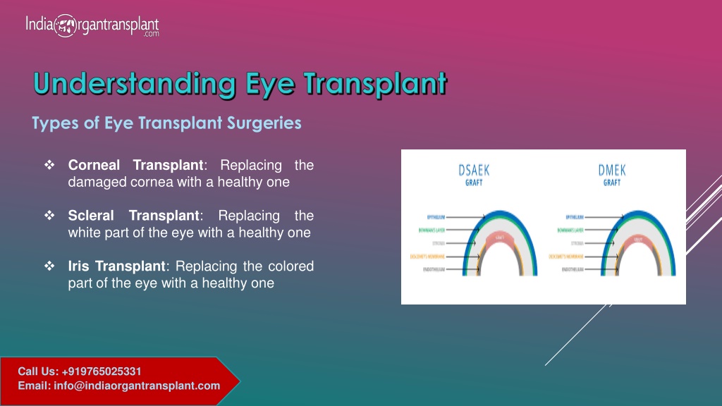 PPT - Planning for Low Cost Eye Transplant Surgery in India PowerPoint ...